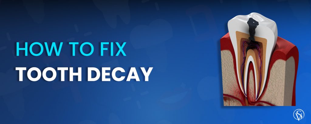 How Do Dentists Fix Tooth Decay?
