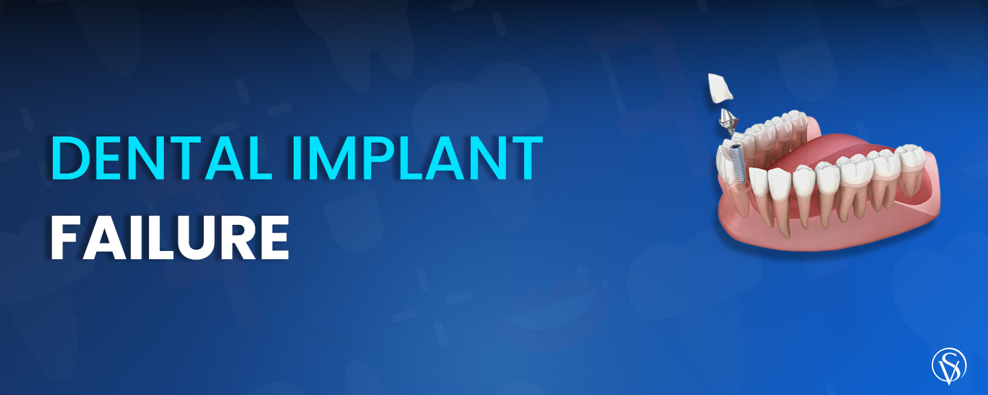 Dental Implant Failure: Causes, Symptoms, and Solutions