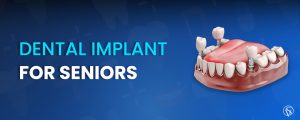 Dental Implants for Seniors: A Complete Implant Guide for Adults Over 60