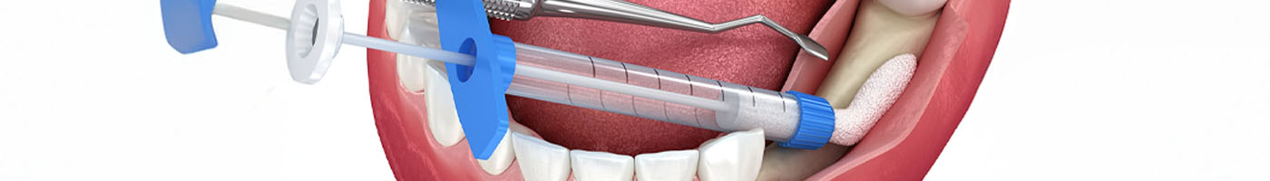 Root Canal Treatment: Procedure, Benefit, and Aftercare - Vera Smile