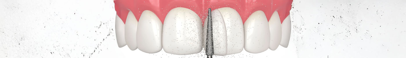 Teeth Whitening - Vera Smile